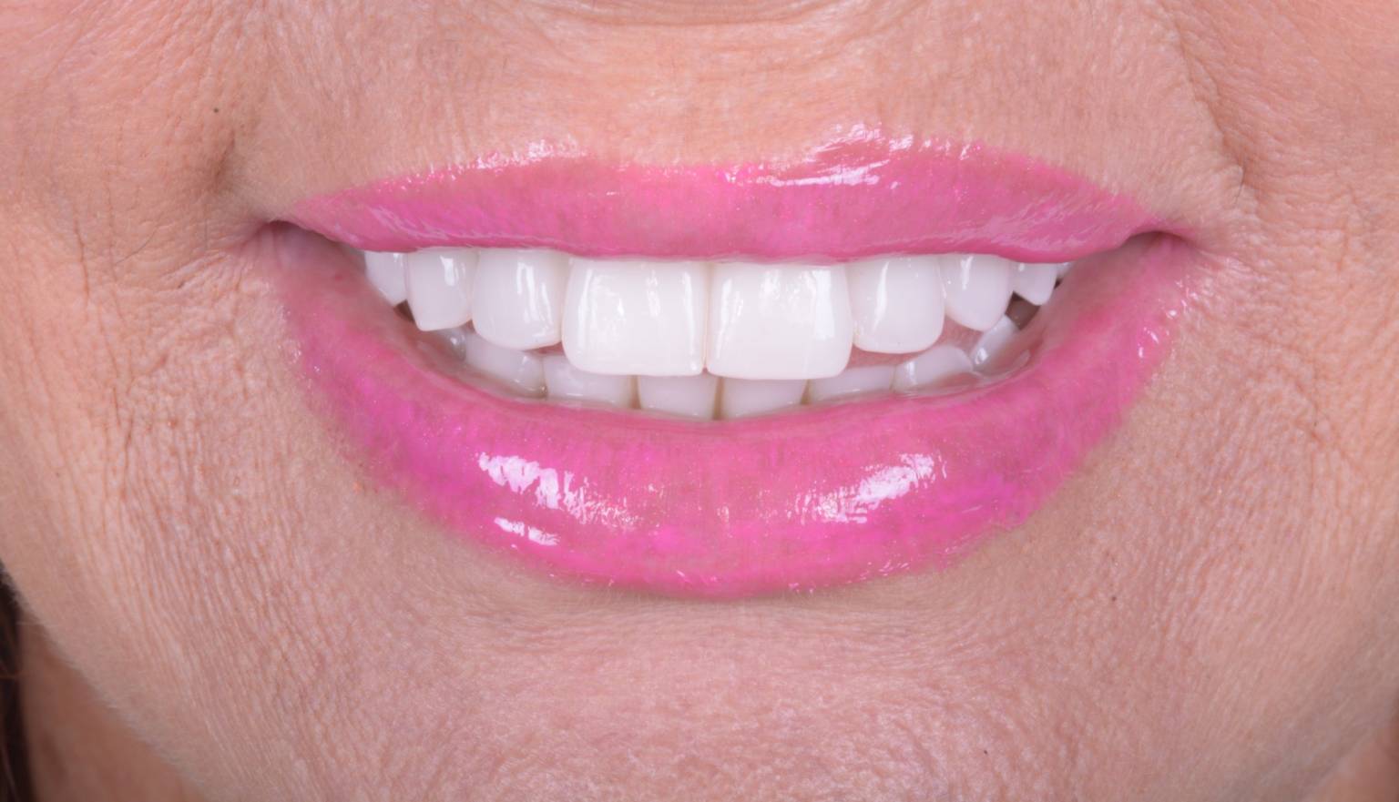 Pre-prosthetic surgery - Studio Calesini